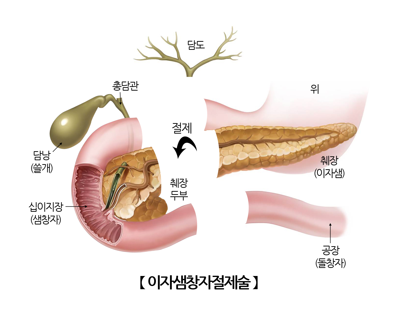 이자샘창자절제술 검사시술수술정보 의료정보 건강정보 서울아산병원