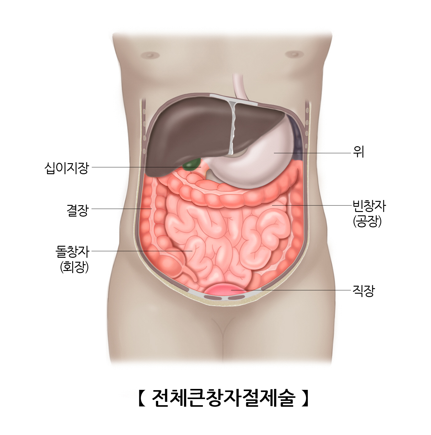 전체대장절제술 검사시술수술정보 의료정보 건강정보 서울아산병원
